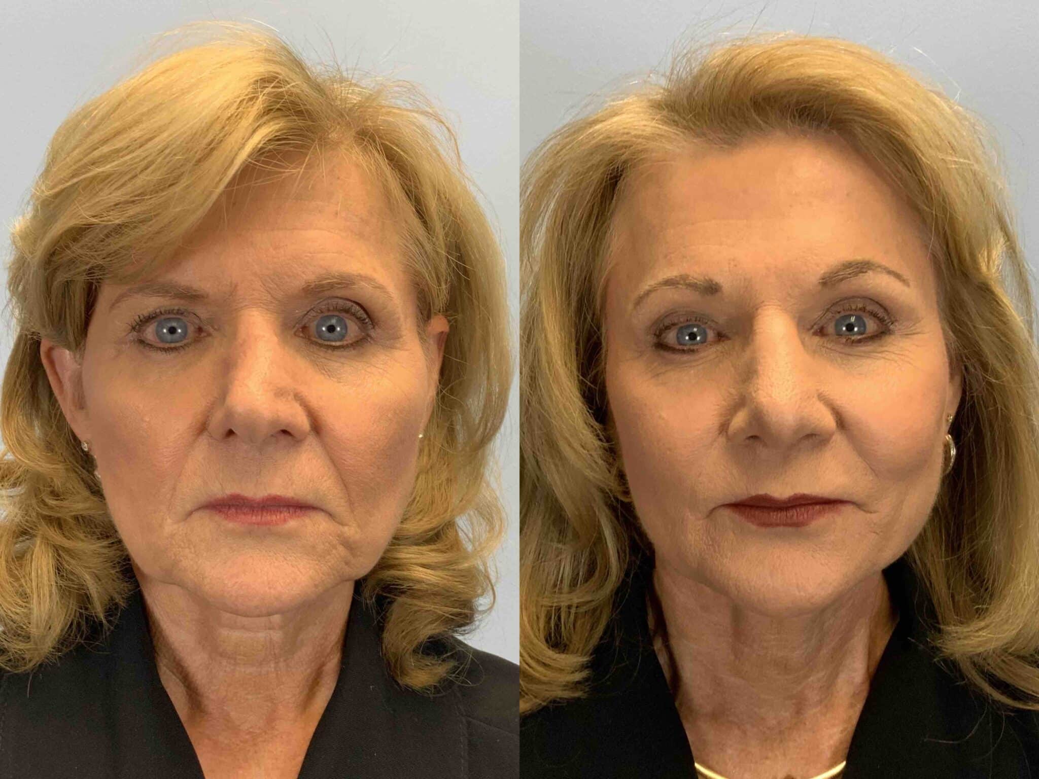 Facial Rejuvenation: Balanced, Natural-Looking Results - Mentor Plastic ...